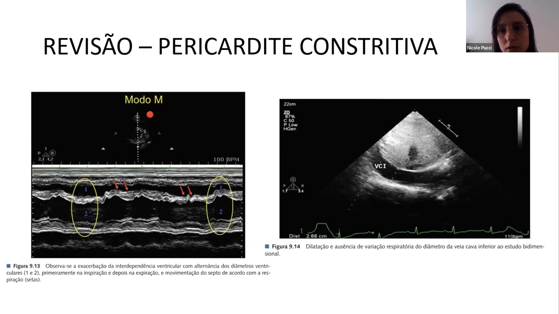 [DEPECO] Caso Clínico: Pericardite Constritiva por TB | makadu.live - 2023