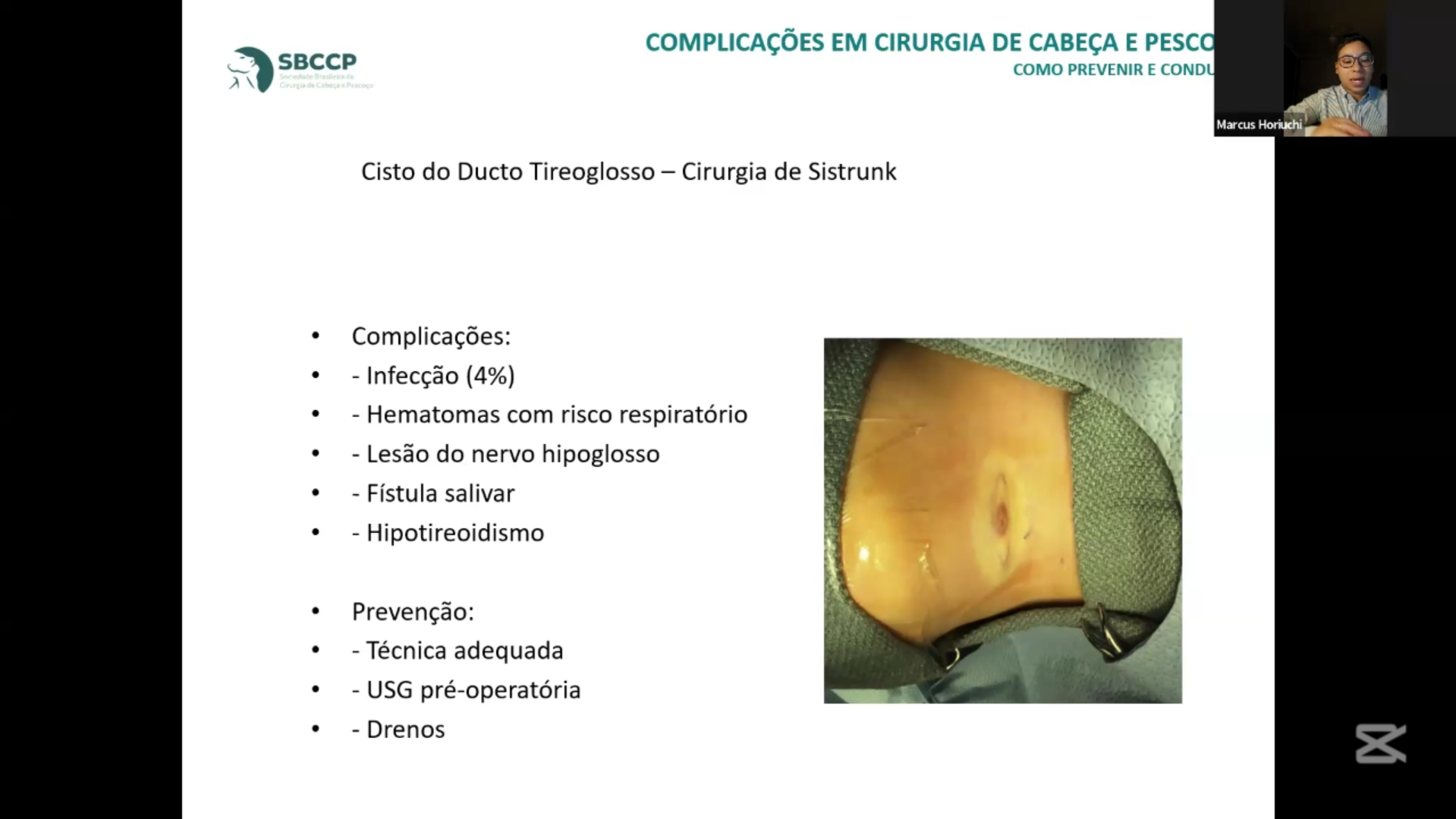 [SBCCP] Videoaula - Complicações do tratamento das doenças congênitas ...