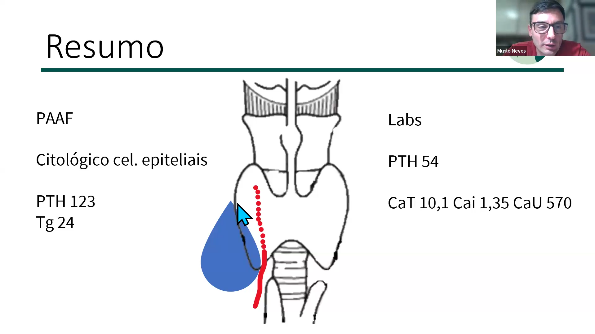 [SBCCP] HPTp com PTH e calcemia normais | makadu.live - 2025